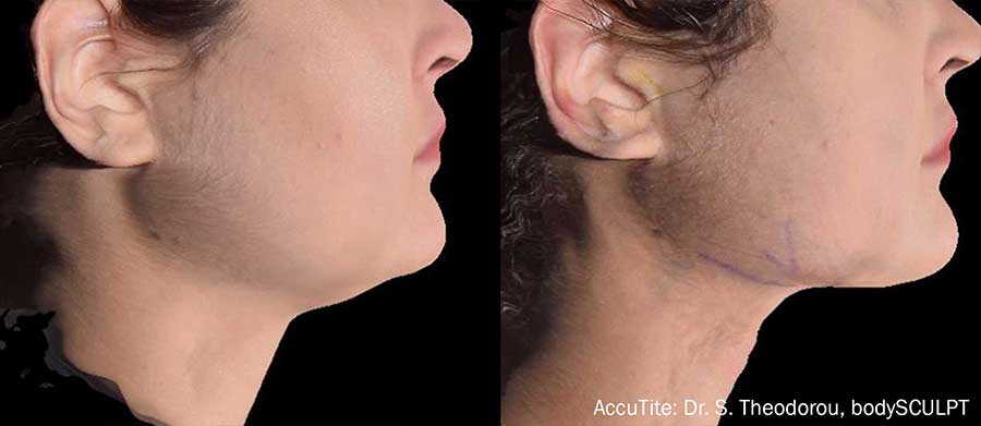 AccuTite - High Precision Minimally Invasive Facial Contouring