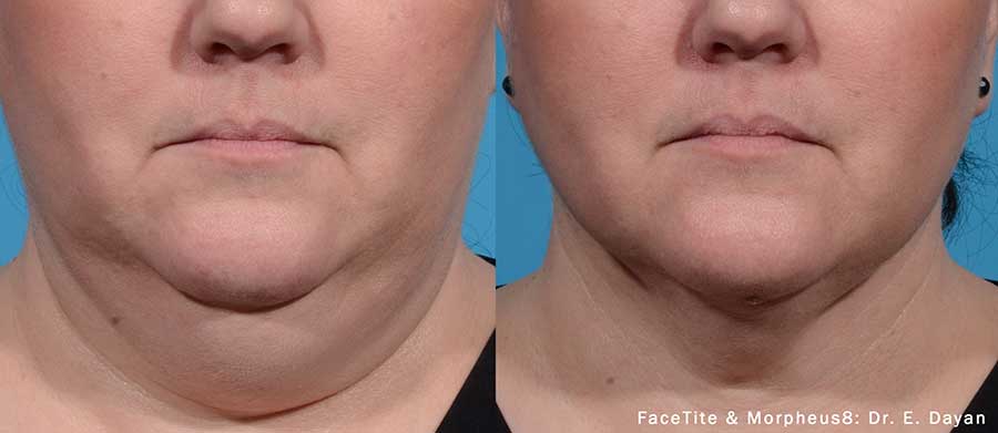 FaceTite - Minimally Invasive Facial Contouring