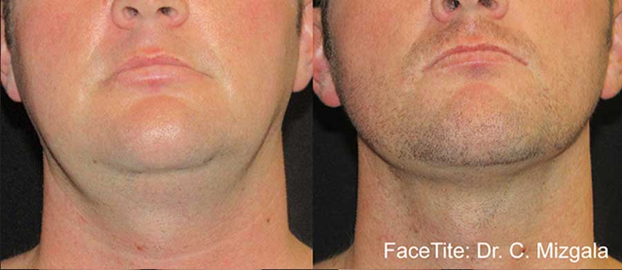 FaceTite RFAL by InMode | Professional Resources & Training