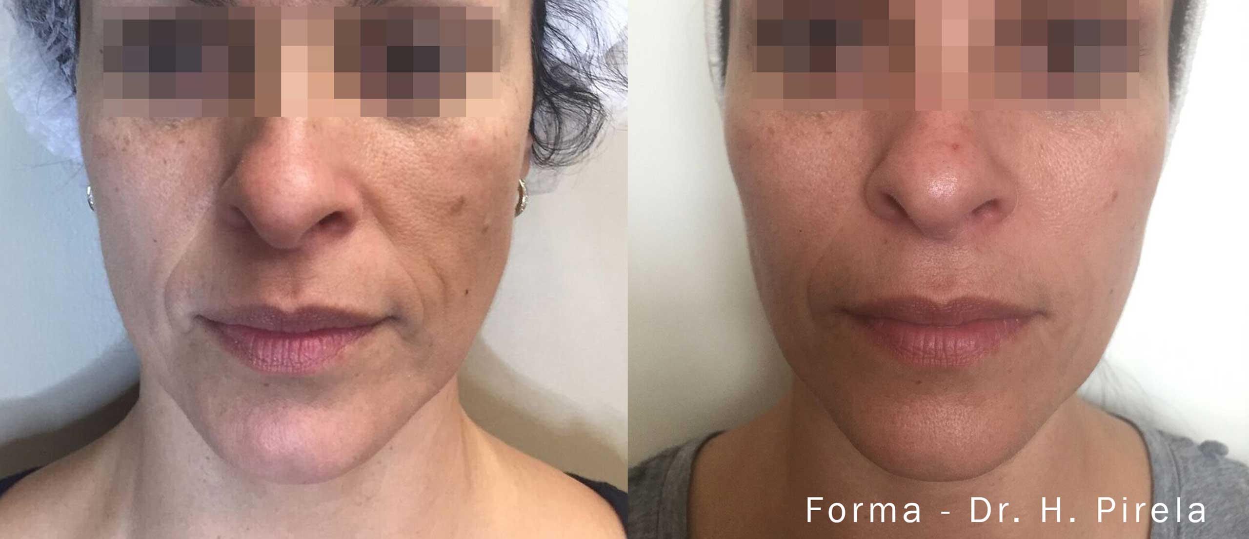Forma - Non-Invasive Anti-Aging Skin & Tissue Remodeling
