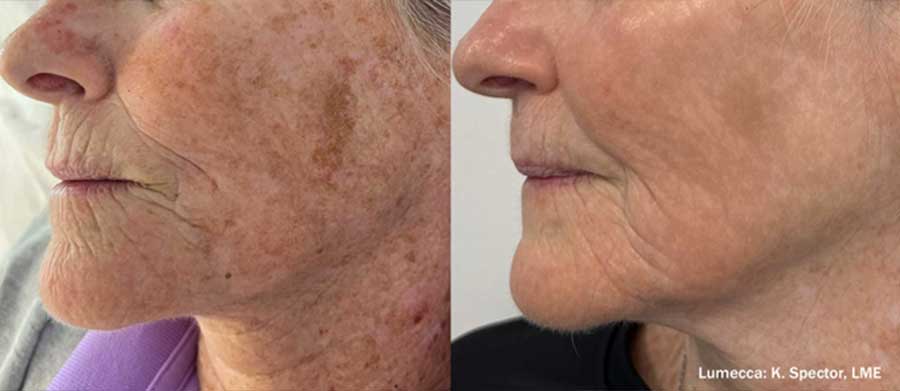 Lumecca IPL by InMode | Technology Resources & Training