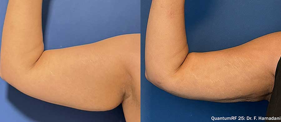 QuantumRF Technology Resources & Training | InMode University