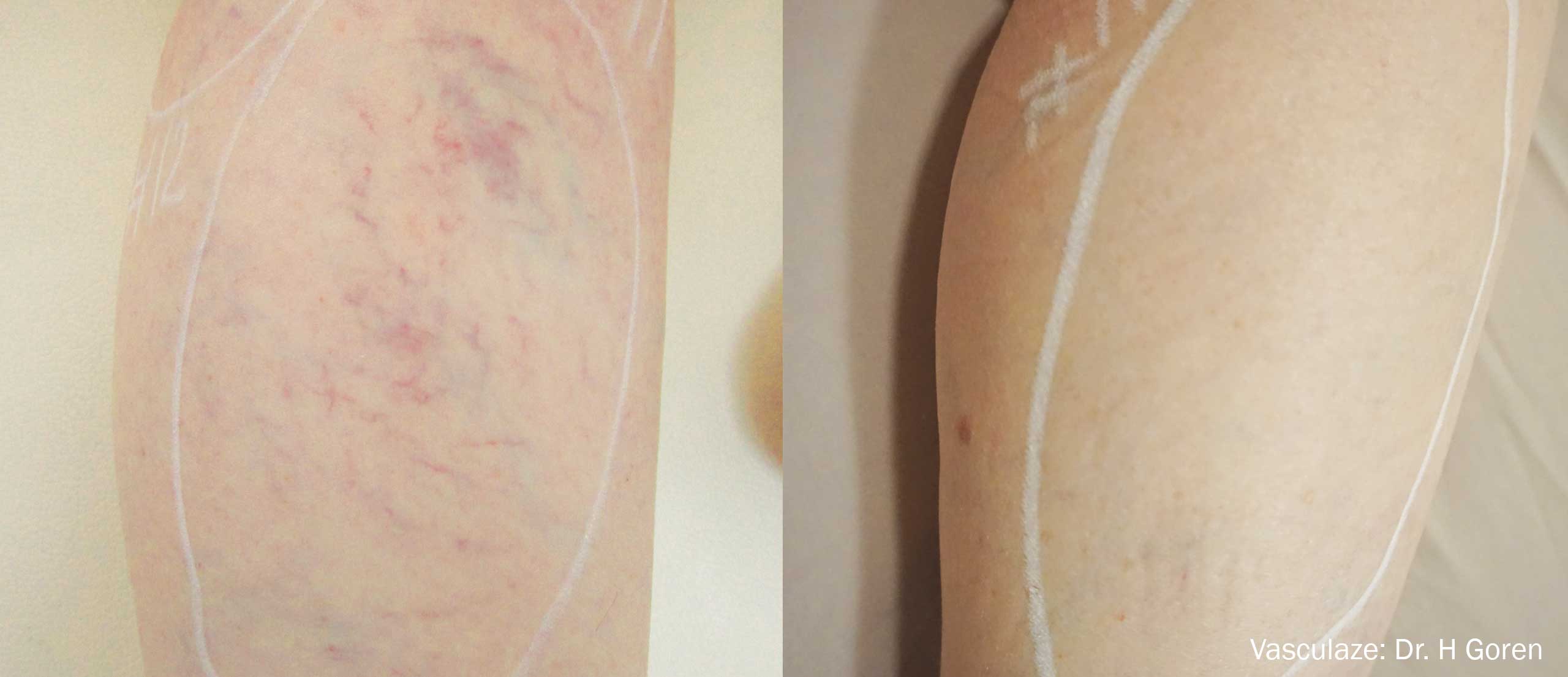 Vasculaze - Vascular Laser Treatment - Spider Vein Removal