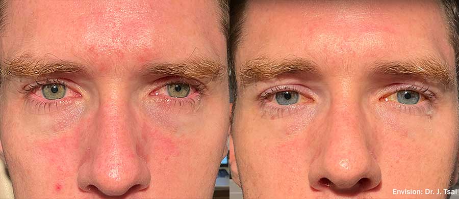 Envision - Forma-I - Non-Surgical Dry Eye Treatment